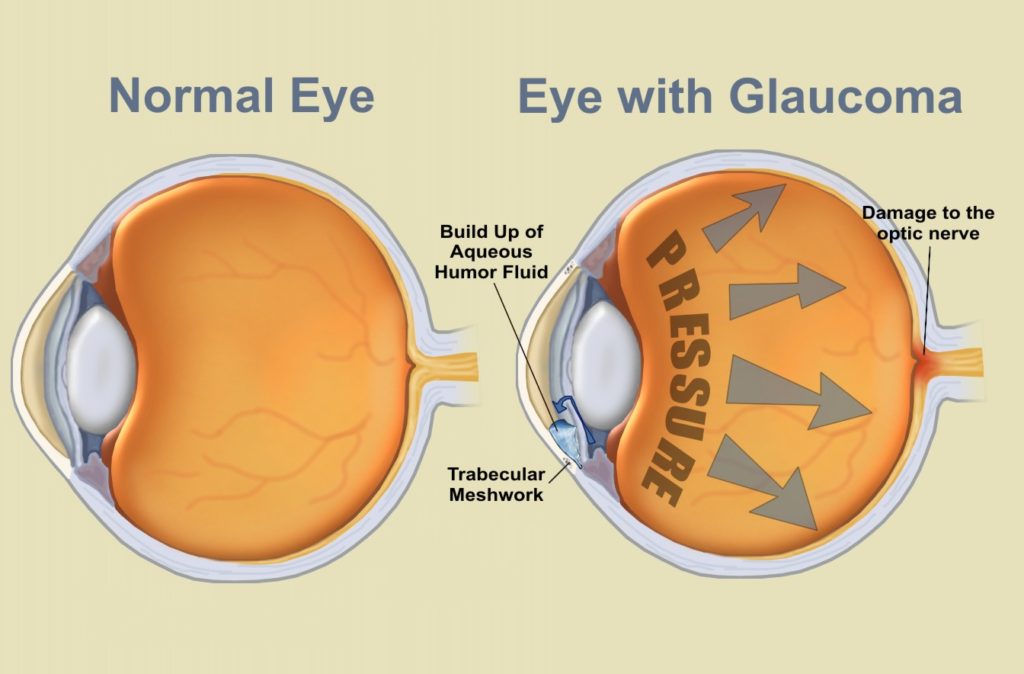 Individuato un nuovo gene che causa il glaucoma nei bambini - MediMagazine
