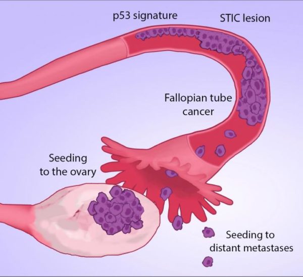 Cancro ovarico: le origini nelle tube di Fallopio – MediMagazine