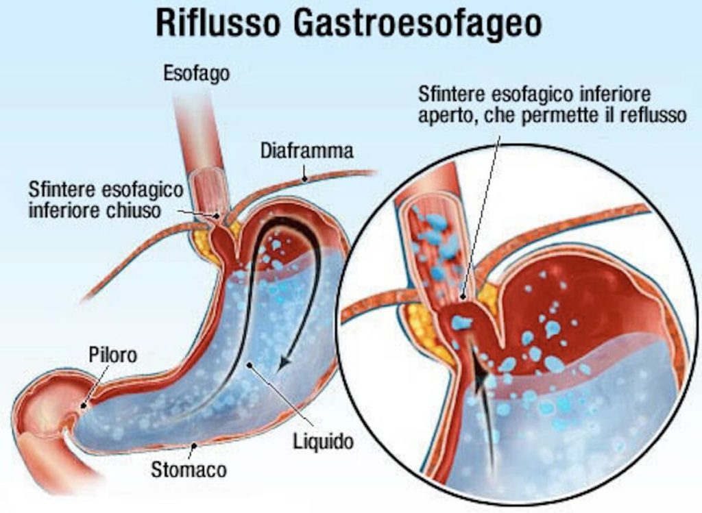 Trattamento per il bruciore di stomaco previene il cancro dell’esofago ...