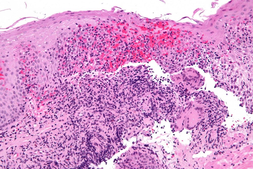 Identificato un fattore chiave nella malattia di Crohn - MediMagazine