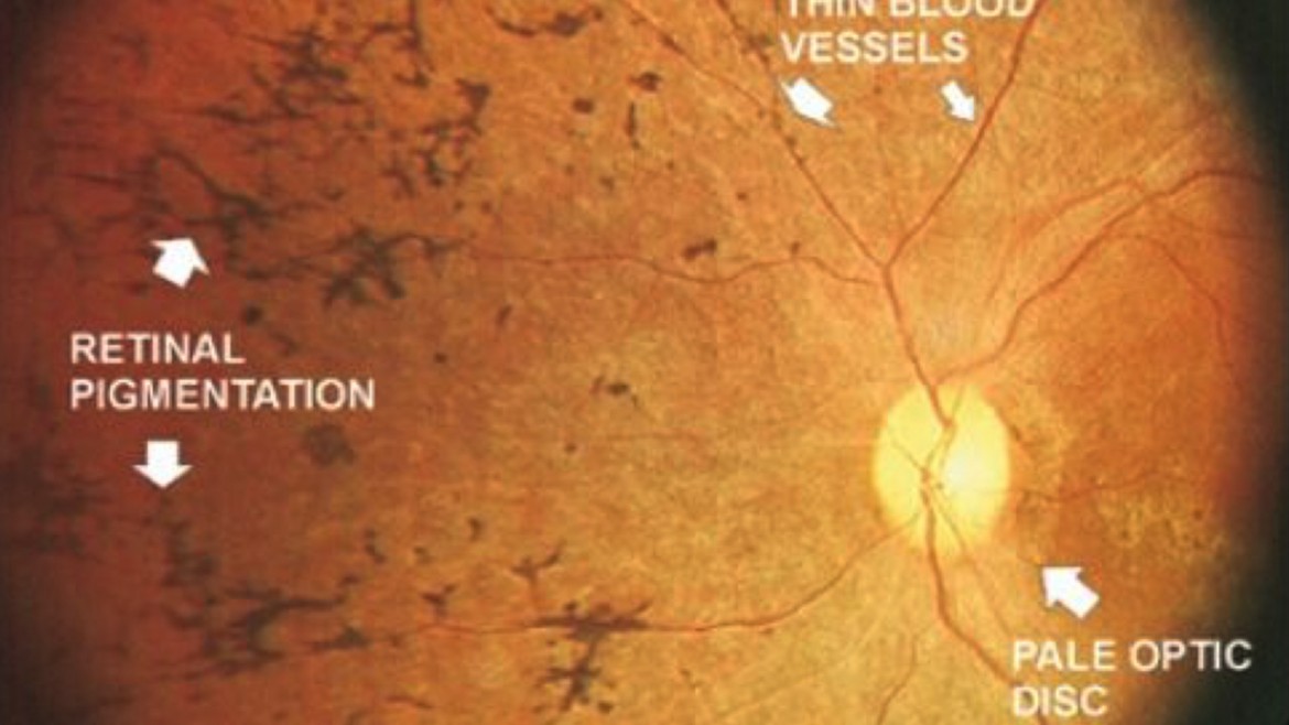 Nuova terapia genica per la retinite pigmentosa - MediMagazine