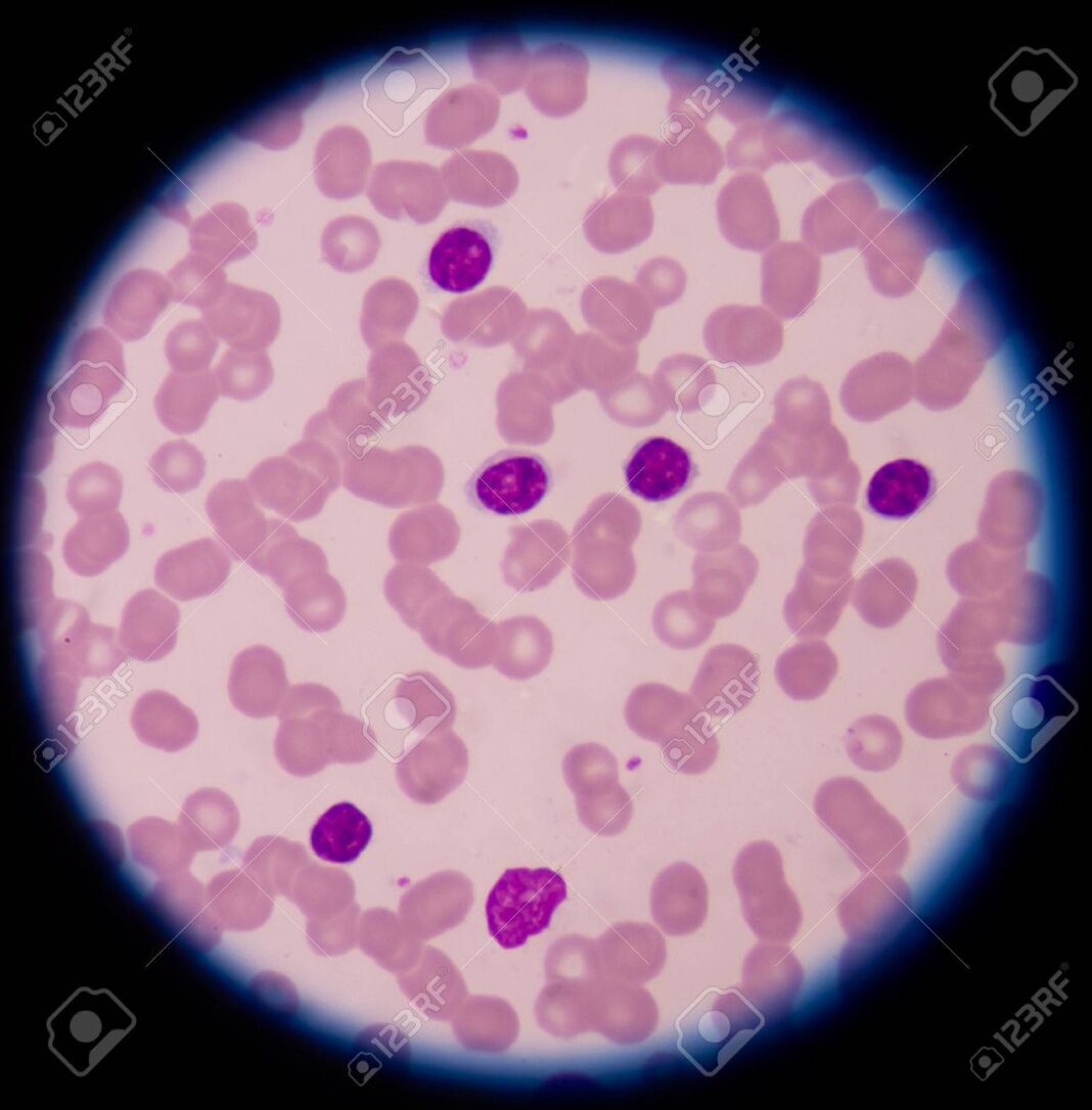 Leucemia linfatica cronica: nuove informazioni dal sequenziamento dell ...