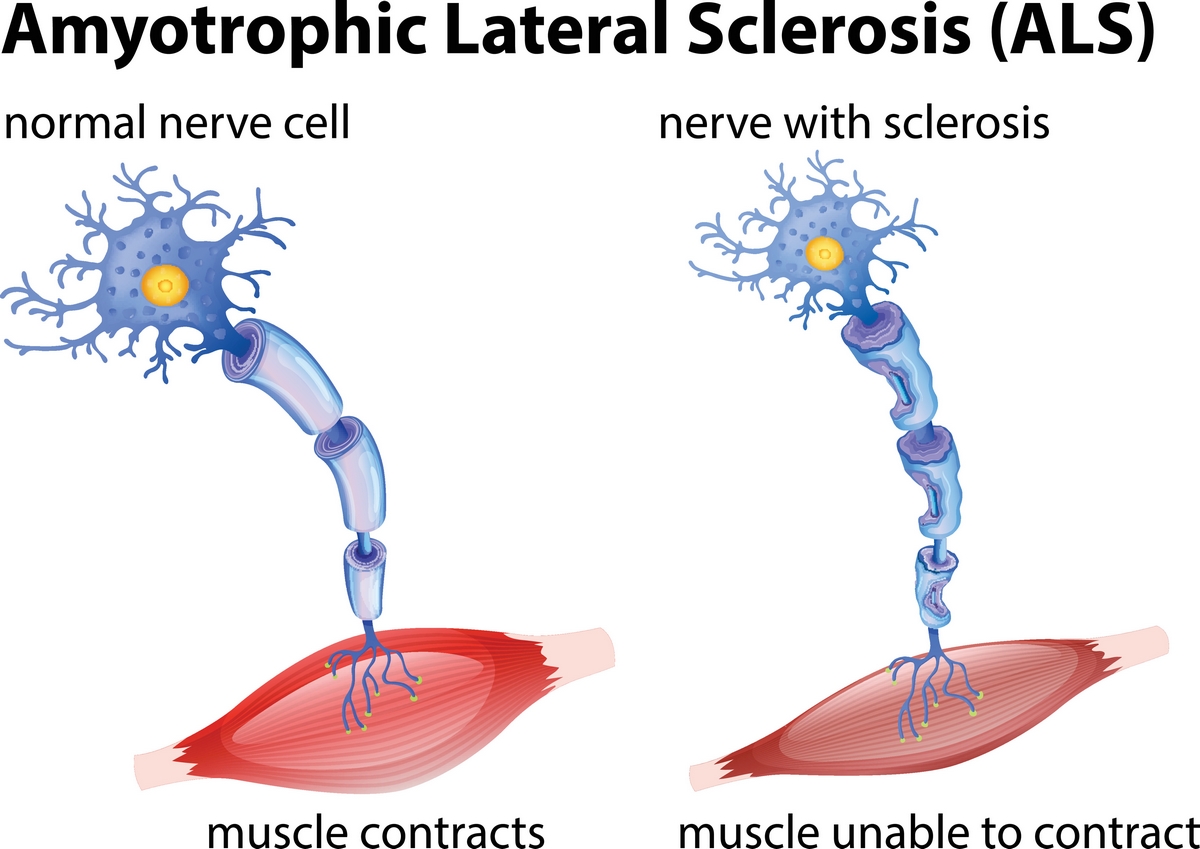 SLA forma genetica: trovata firma infiammatoria distintiva - MediMagazine