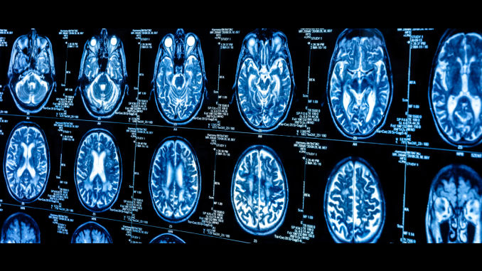SLA: individuato nuovo target terapeutico - MediMagazine
