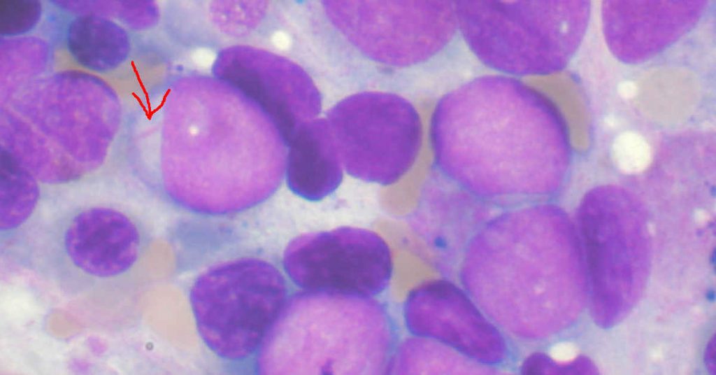 Leucemia mieloide acuta: studio pilota di fase 2 sull’infusione di ...