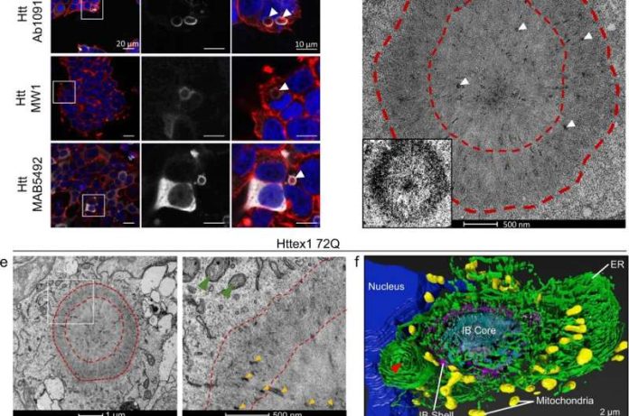 Malattia di Huntington: rivelata l'ultrastruttura delle inclusioni ...