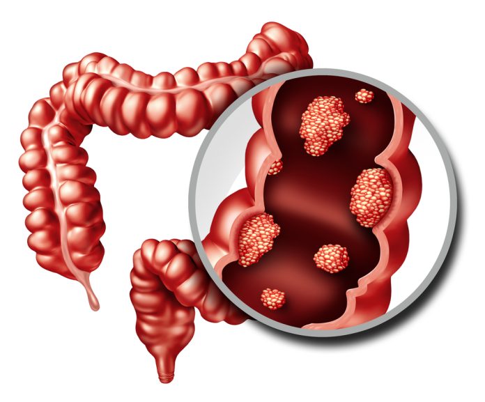 Cancro del colon-retto: come ridurre il rischio - MediMagazine Cancro del colon-retto: come ridurre il rischio - MediMagazine